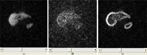 A One Slice From A Reconstructed Spect Liver Dataset 3d Wavelet