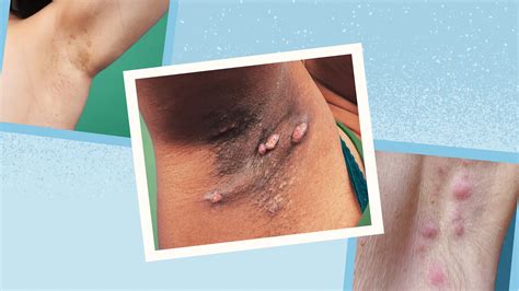 How Do You Treat Hidradenitis Suppurativa Tunnels