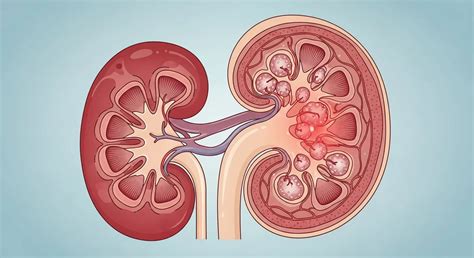 Glomerulonephritis Causes Symptoms And Effective Treatments