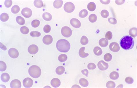 Images Of Anemia