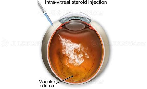 Intravitreal Kenalog Injection