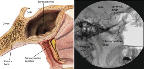 Trigeminal Nerve Neurodestructive Procedures Anesthesia Key