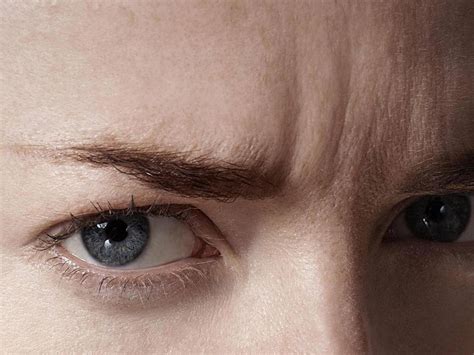 Furrowed Brow Wrinkles