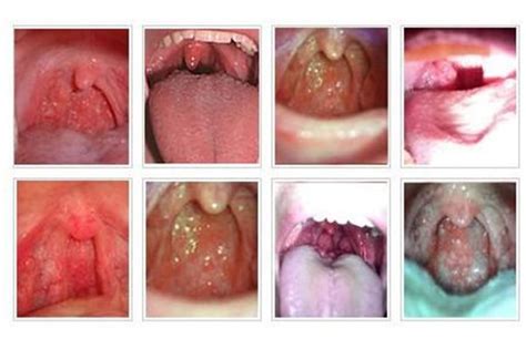 舌根部淋巴滤泡增生 6有来医生