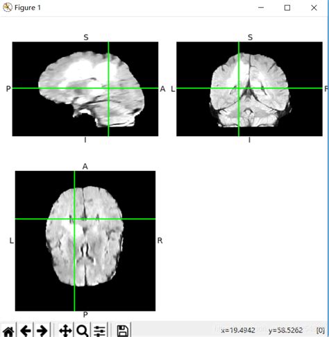 如何读取nifti格式图像(nii文件)nii格式nifti打不开 Csdn博客 如何读取nifti格式图像(nii文件)nii格式nifti打不开 Csdn博客