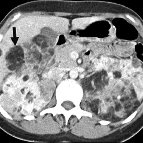 Pdf Fat Containing Lesions Of The Liver Cross Sectional Imaging Findings With Emphasis On Mri