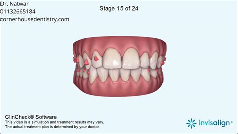 Posterior Crossbite Anterior Crossbite Asymmetric Arches Mandibular Midline Deviation Youtube