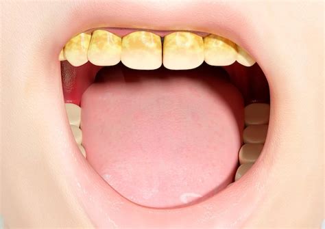 Premium Photo Tartar On Human Teeth Causes Calcification Of The