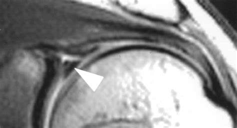 Diagnostic Performance Of Mr Arthrography In The Assessment Of Superior