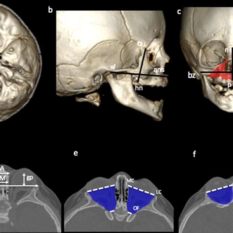 Skull Shape Severity Quantification Using Traditional Cephalic Index