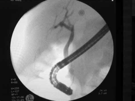 Recurrent Pyogenic Cholangitis In A Case With Congenital Biliary