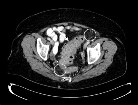 Sigmoid Diverticulitis Sigmoid Colon With Multiple Diverticula Download Scientific Diagram