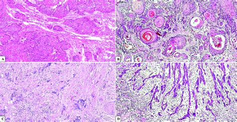 Hematoxylin And Eosin Stained 5 µm Sections Of Oral Squamous Cell