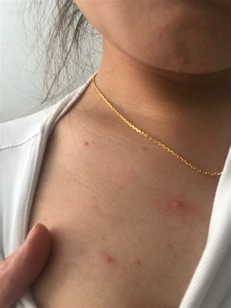 胸前长痘痘 胸口毛囊炎 伤感说说吧