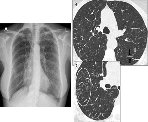 Diffuse Panbronchiolitis A Very Rare Disease In Western Countries Archivos De Bronconeumología