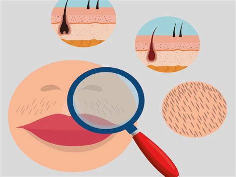 Pcos Awareness Month 5 Telltale Signs That Indicate You Have The