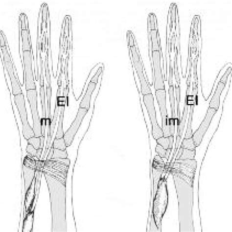 A Slip From The Extensor Indicis Proprius Muscle Ei Tendon Joins The