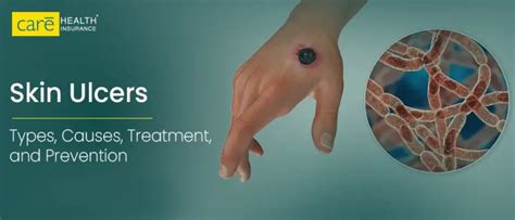 Ulcer Skin Descriptions