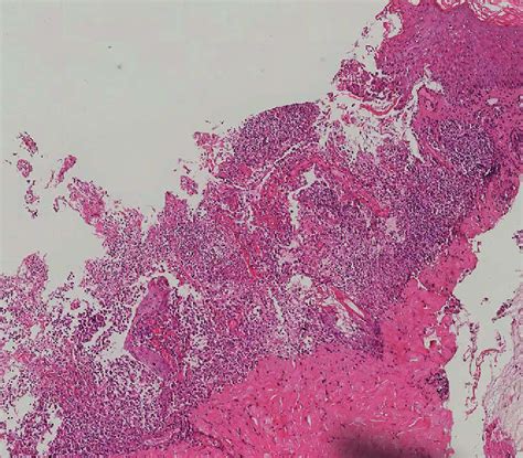 Figure 2 From A Case Of Pustular Pyoderma Gangrenosum Misdiagnosed As
