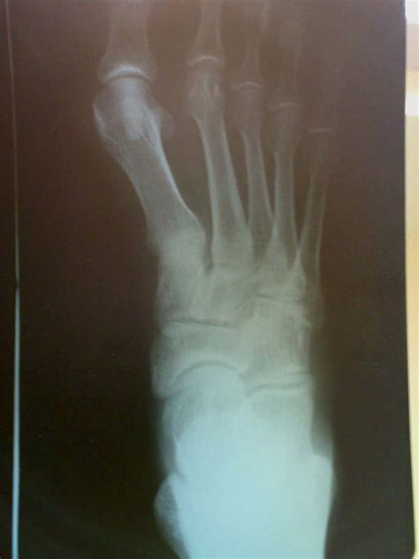 Isolated Complete Plantar Dislocation Of First Metatarsocuneiform First Tarsometatarsal Joint