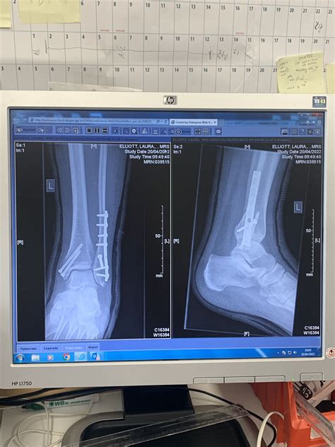 Intraosseous Lipoma And Fibular Fracture Artofit