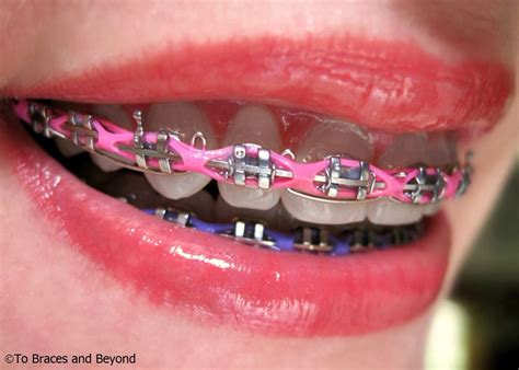 Is Hot Pink A Good Color For Braces Bumbu Manis