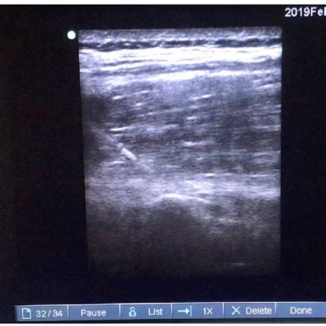 T10 Vertebra Transverse Process Download Scientific Diagram