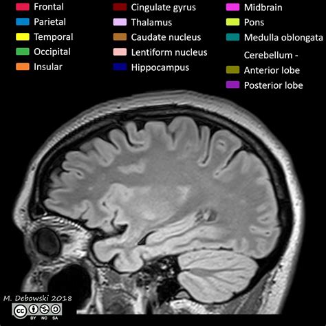 Brain Lobes Annotated Mri Radiopaedia 61691 69700 Sagittal Nc Commons