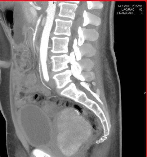 Rectal Gist Tumor Colon Case Studies Ctisus Ct Scanning