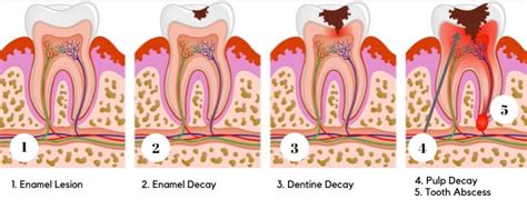 ШҮД ЦООРОХ ӨВЧИН Налайх Эрүүл Мэндийн Төв Шүд Зөвөлгөө