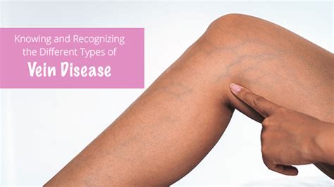 Knowing And Recognizing The Different Types Of Vein Disease
