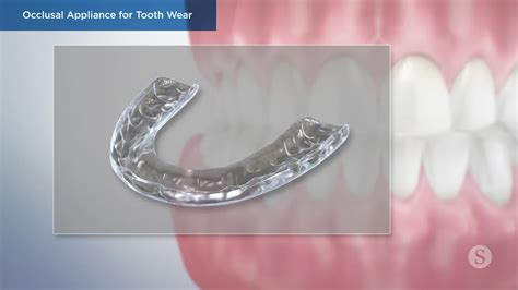 Force Distribution On Occlusal Splints Using T Scan 57 Off