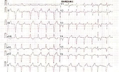 Electrocardiogram Shows Pacemaker Rhythm Of 80 Beats Min And Pacing