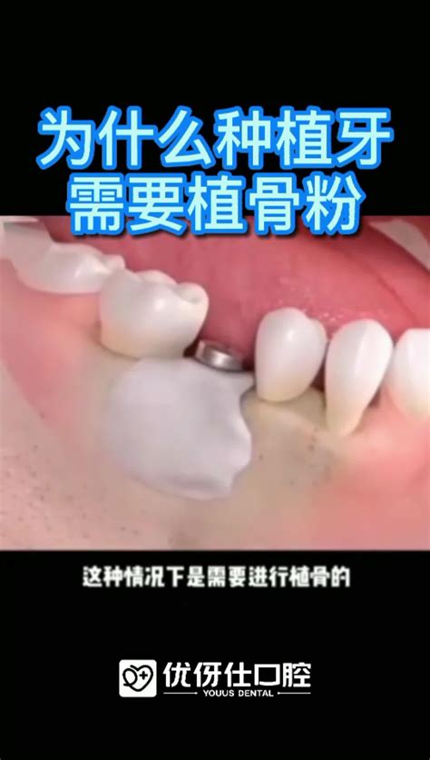 为什么有些人的种植牙需要骨粉骨膜？ 知乎