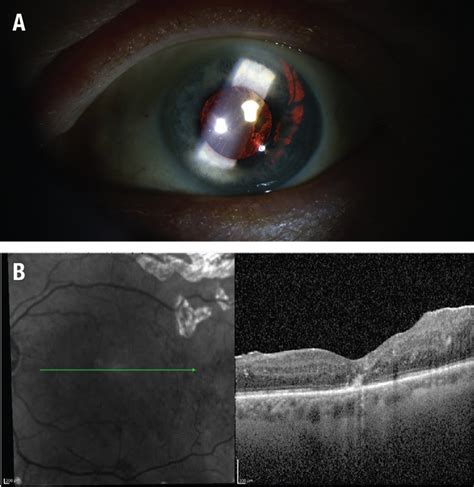 Iris Transillumination Defects