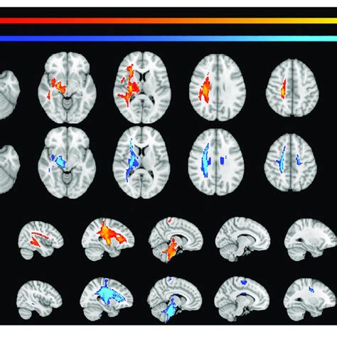 Structural Disconnection Frequency Map 75 Voxels Of White Matter