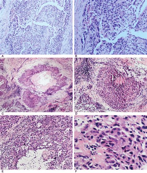 Morphological Features Of The Tumor In The First Sample The Tumor Download Scientific Diagram