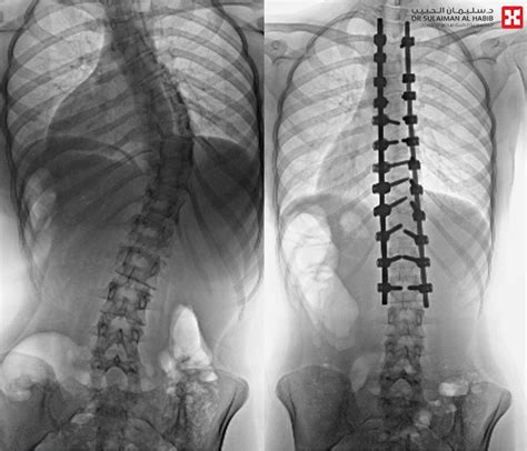 صحيفة سبق نجاح لافت لجراحات تقويم العمود الفقري الجنف بمستشفى