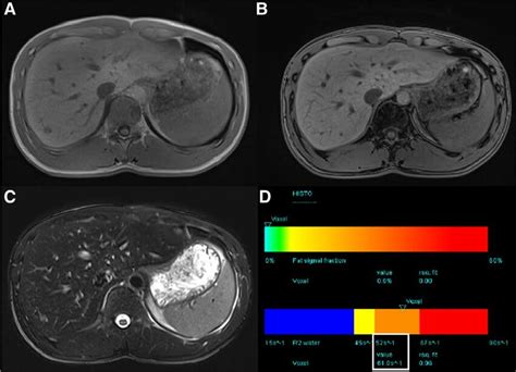 Liver Iron Storage At Ruben Williams Blog