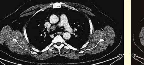 3a Cross Sectional Ct Scan Of The Thorax Showing A Station