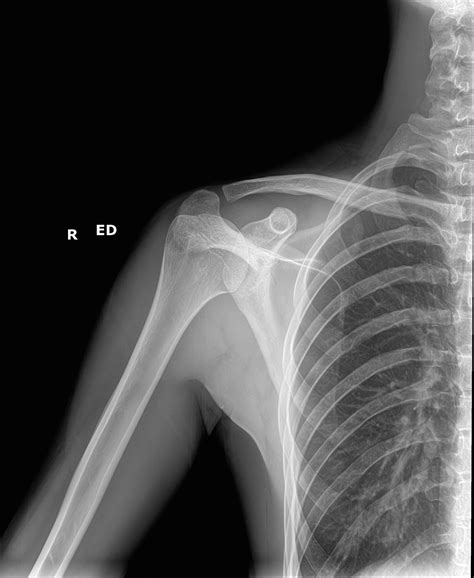 Orthodx Fracture Of The Coracoid Process Clinical Advisor