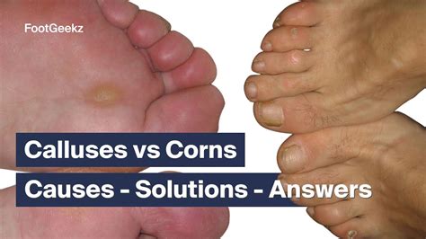 Corn Vs Callus Difference At Ellie Gillespie Blog