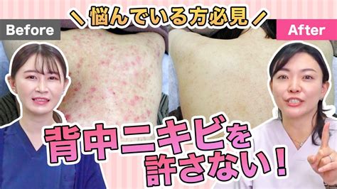 【背中ニキビ】ケアしづらい背中ニキビも美容医療なら解決できる！ Youtube
