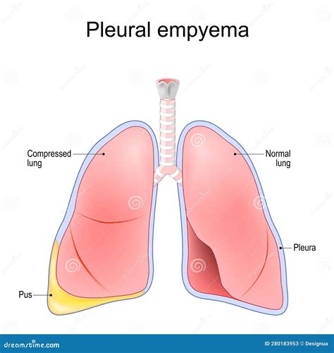 Pleural Empyema Normal Lung And Lungs After Accumulation Of Pus Stock Vector Illustration Of