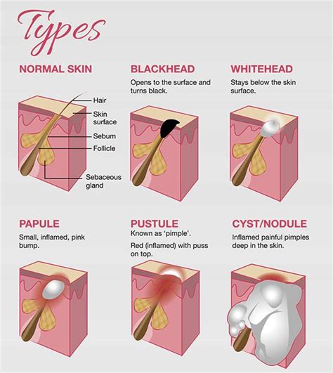 Types Of Acne Skin Advice Skin Tips Facial Skin Care Routine Face Skin Care Acne Treatment