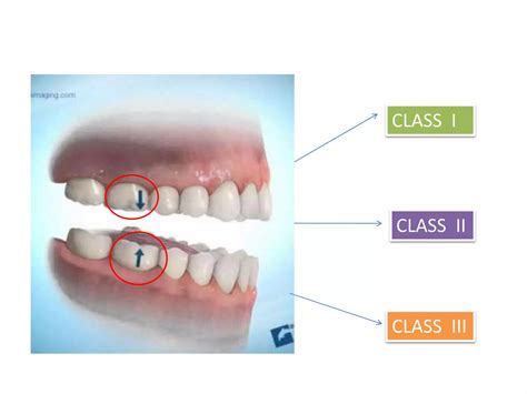 Angles Classification Of Malocclusion Ppt