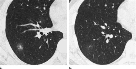 Resolution Of Nodular Ground Glass Opacity Over Time Helps Determine Download Scientific