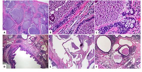 A Hybrid Lesion Of Intralobar Sequestration With Mixed Features Of Cpam Type I And Type Ii