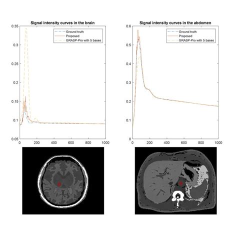 Comparison Of Estimated Dce Mri Signal Time Curves For The Proposed
