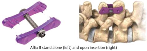 8 Spinous Process Fixation Systems Neupsy Key
